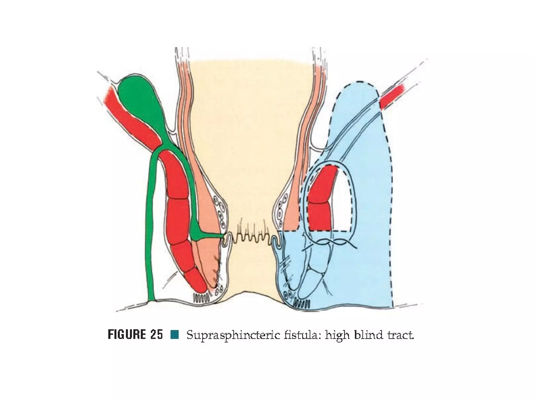 Fistula in-ano | PPT