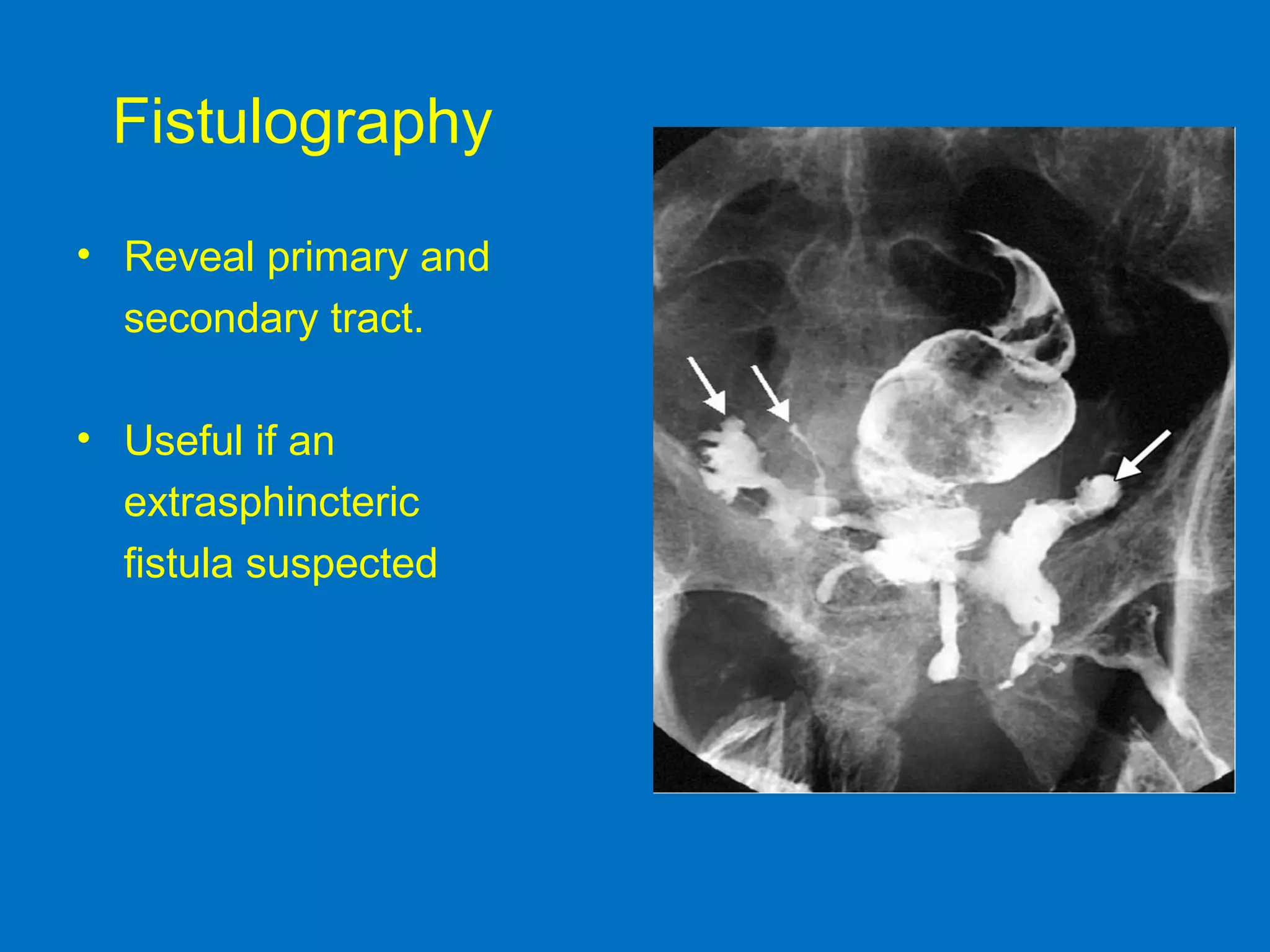 Fistula in-ano | PPT
