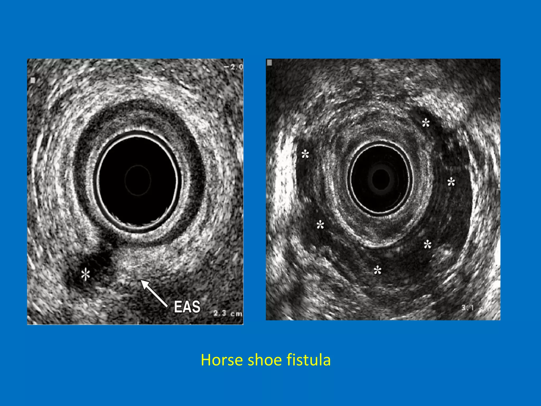 Fistula in-ano | PPT