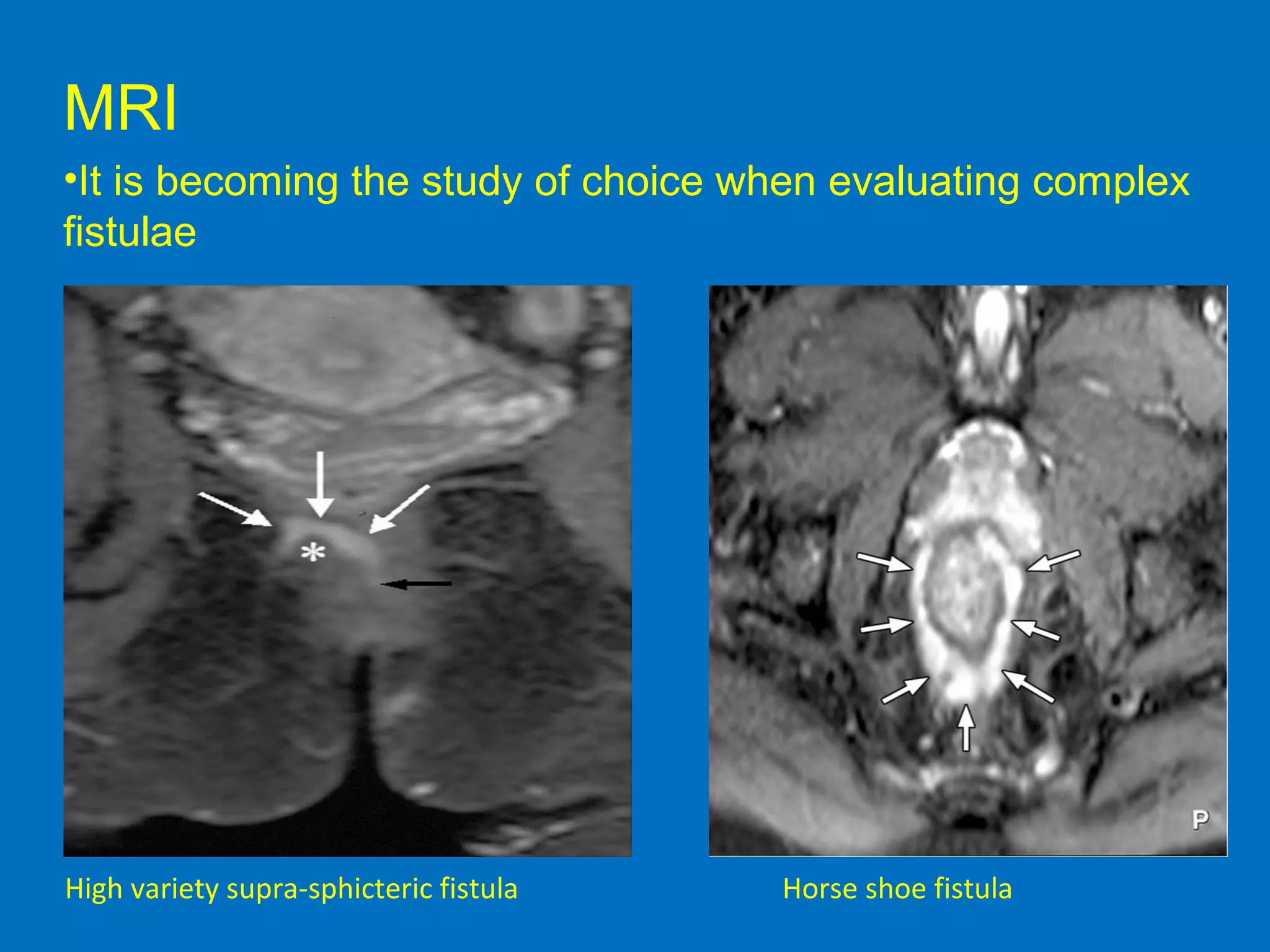 Fistula in-ano | PPT