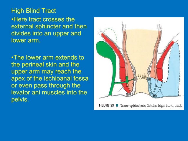 Fistula in-ano | PPT | Digestive Disorders | Diseases and Conditions