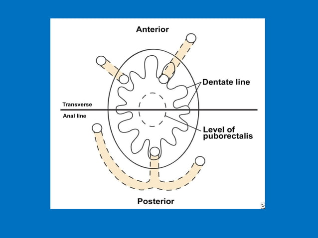 Fistula in-ano | PPT | Digestive Disorders | Diseases and Conditions