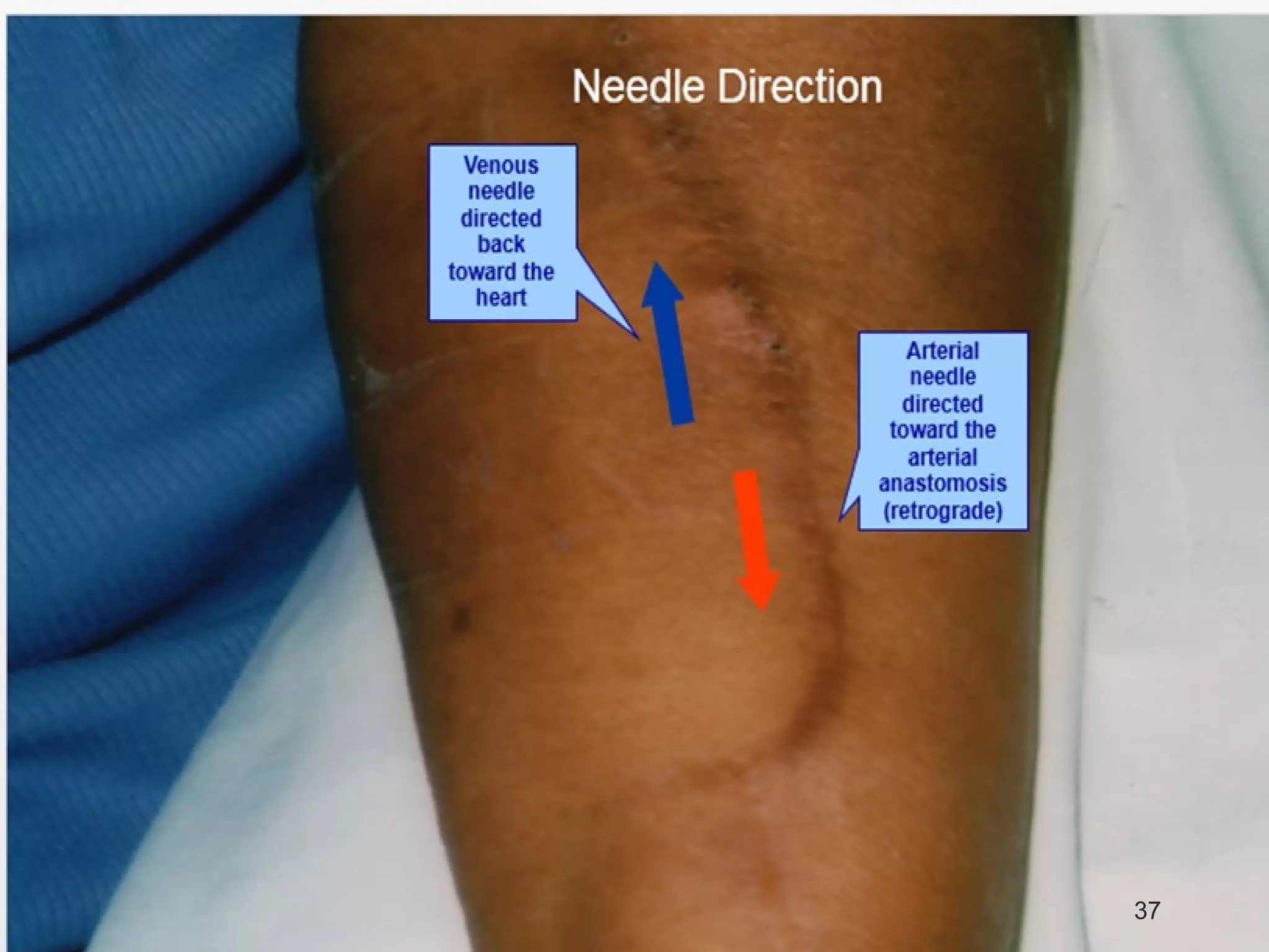 Fistula (Arteriovenous fistula -AVF) | PPT