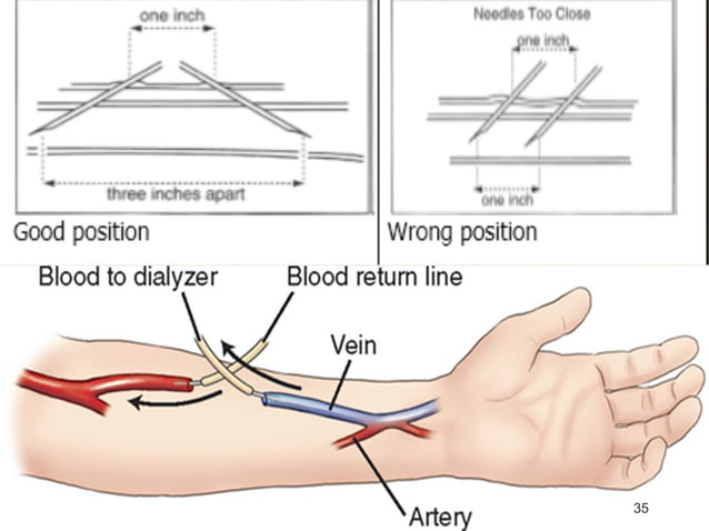 Fistula (Arteriovenous fistula -AVF) | PPT
