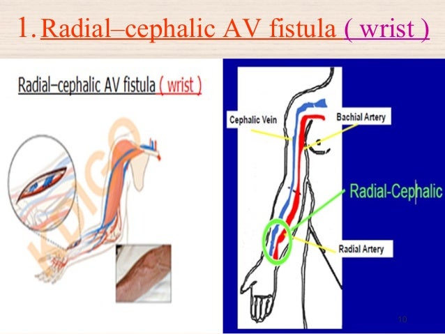 Fistula (Arteriovenous fistula -AVF)