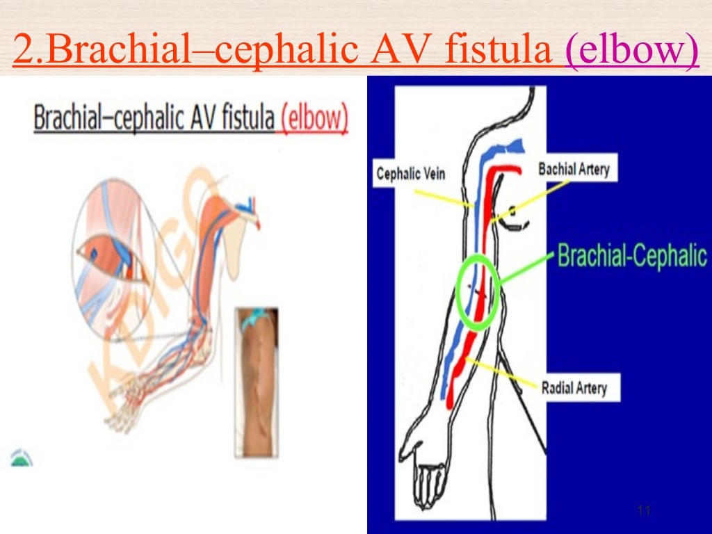 Fistula (Arteriovenous fistula -AVF)