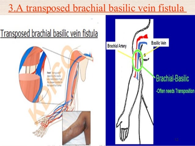 Fistula (Arteriovenous fistula -AVF)