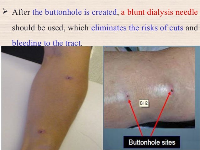 Fistula (Arteriovenous fistula -AVF)