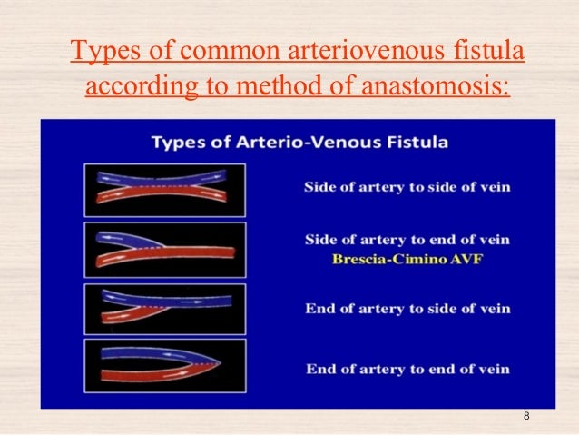 Fistula (Arteriovenous fistula -AVF)