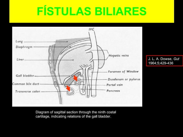 FISTULAS BILIARES | PPT