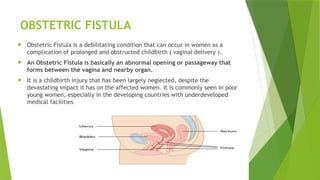 FISTULA confirm.pptx9999999999999999999999999999999 | PPT