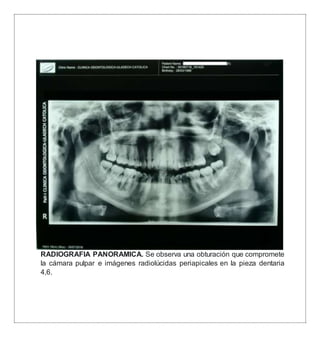 FÍSTULA CUTÁNEA ODONTOGÉNICA | DOCX