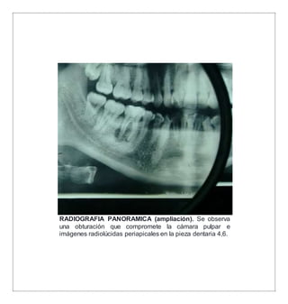 FÍSTULA CUTÁNEA ODONTOGÉNICA | DOCX