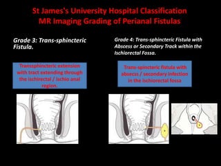 Fistula in ano | PPT