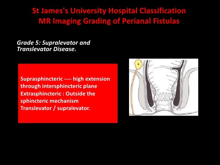 Fistula In Ano