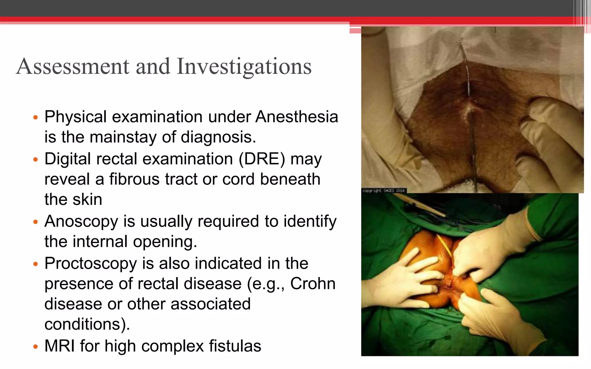 Fistula in ano | PPTX
