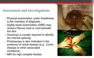 Fistula in ano | PPTX