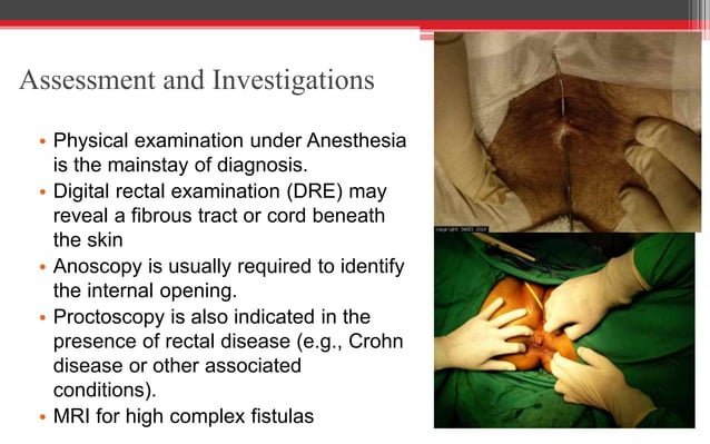 Fistula in ano | PPTX