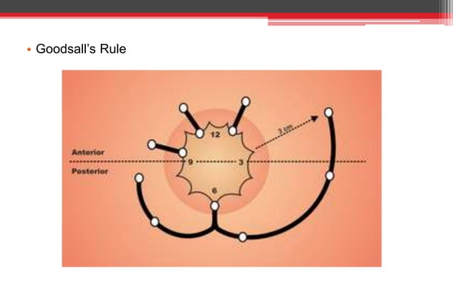 Fistula In Ano Pptx