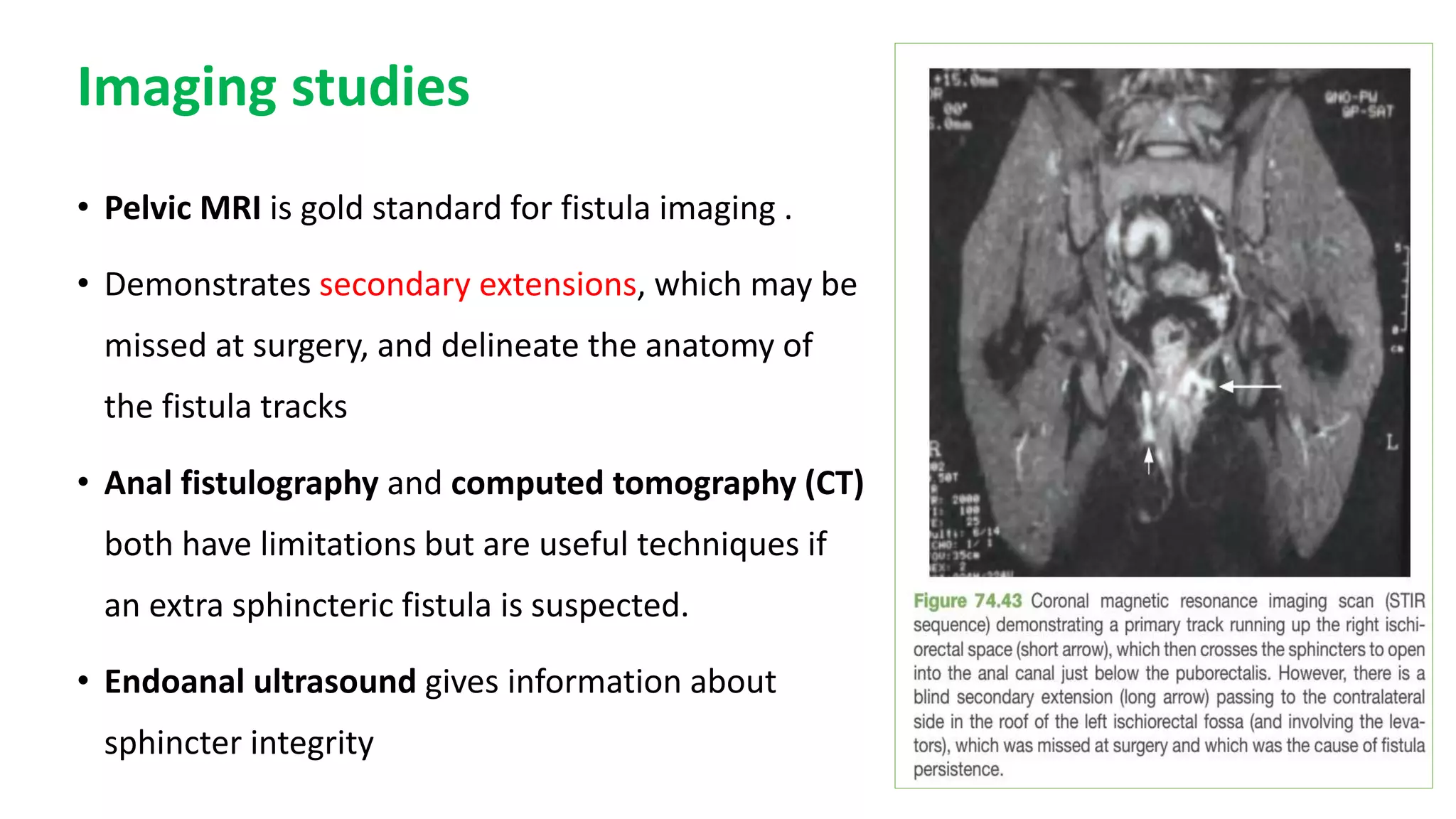 Fistula In Ano Ppt