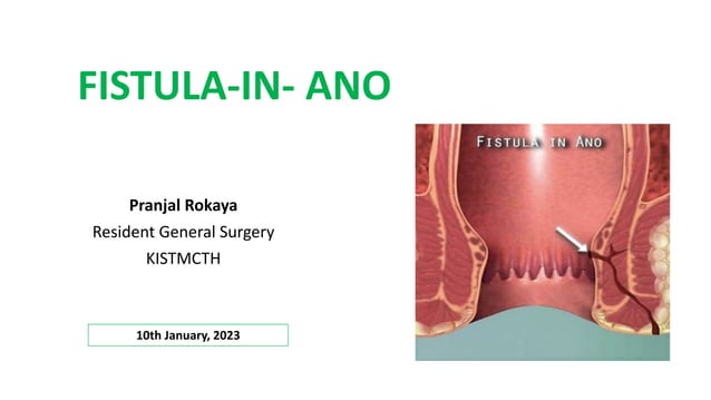 Fistula In Ano Causes Types And Treatment Options Ppt