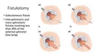 Fistula in Ano.pptx