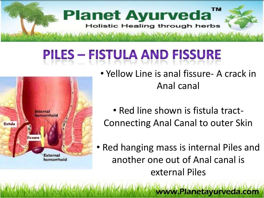 Fistula in Ano- Causes, Symptoms and Treatment in Ayurveda