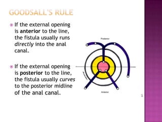 Fistula in ano | PPTX