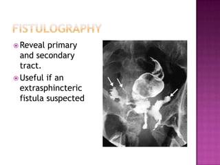 Fistula in ano | PPTX