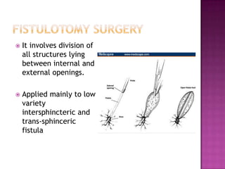 Fistula in ano | PPTX
