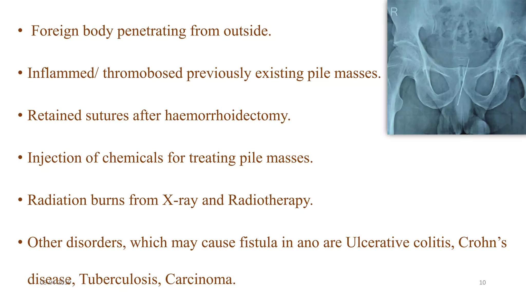 Fistula in ano by Dr.Abhishek S L | PDF