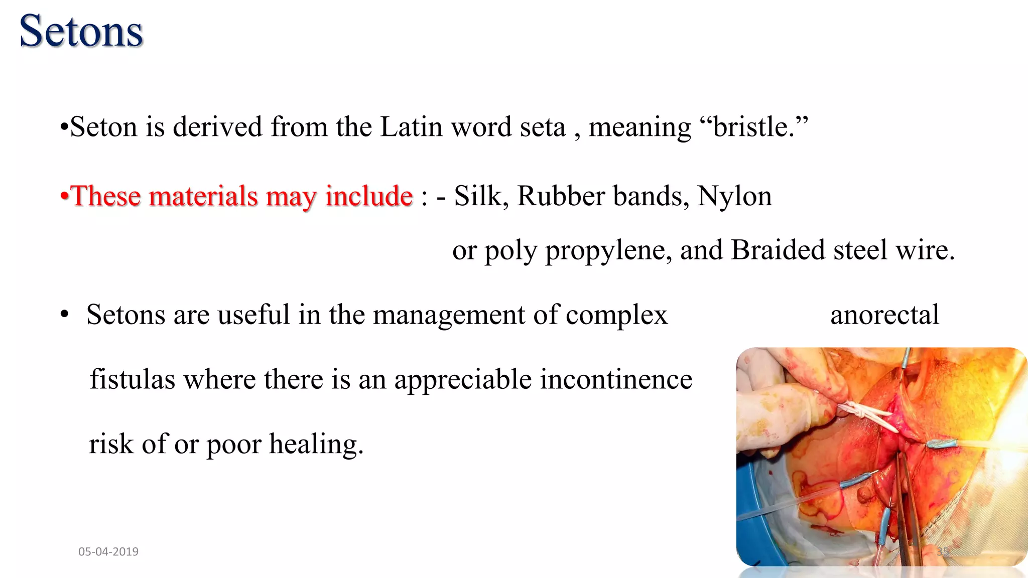 Fistula in ano by Dr.Abhishek S L | PDF