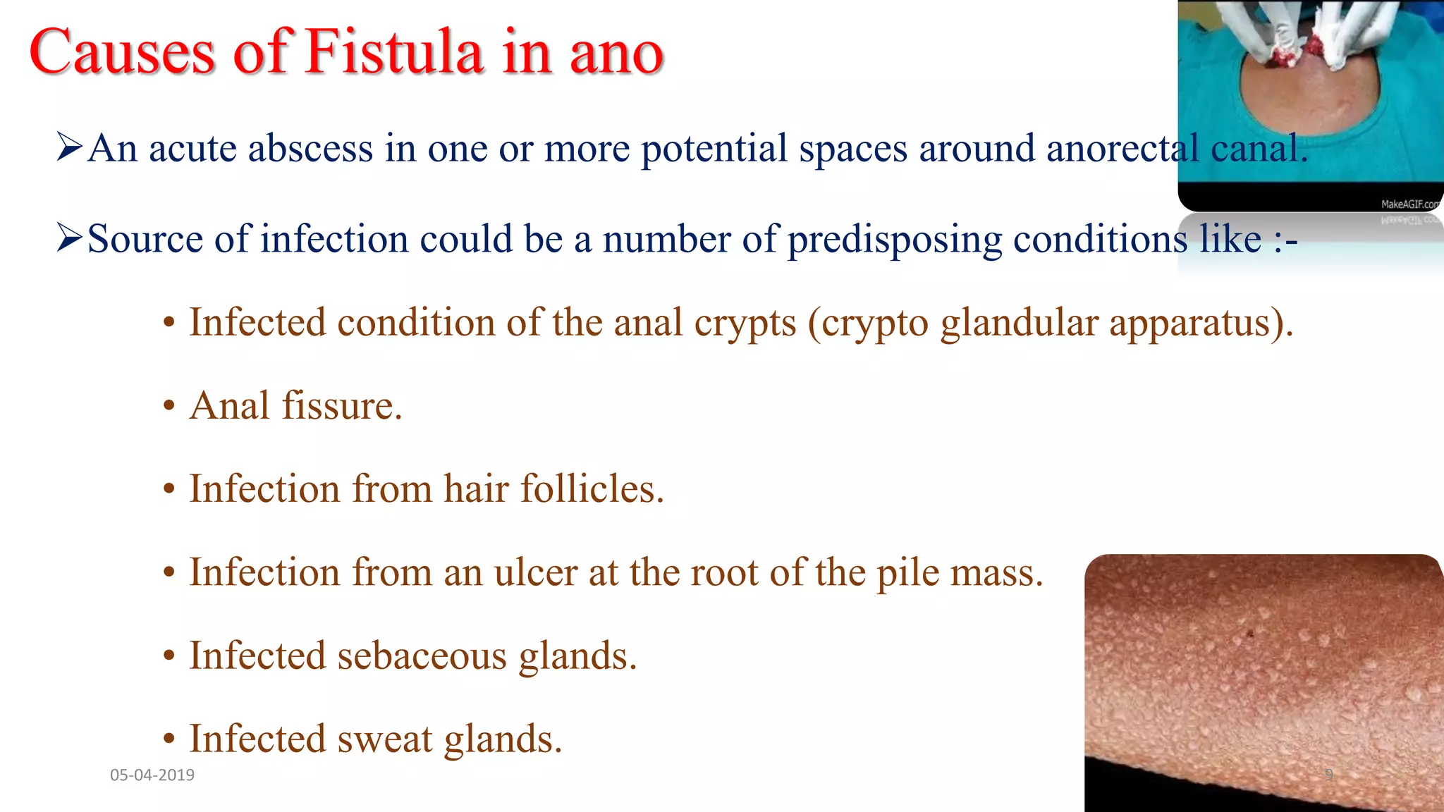 Fistula in ano by Dr.Abhishek S L | PDF