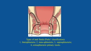 fistula in ano ppt ajajajannanananananaj | PPTX