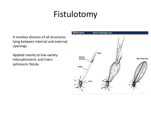 Fistula in ANO