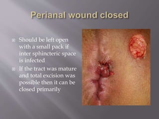 Fistula in ano sloft technic by dr d.u.pathak | PPT