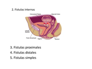 Fistulas | PPTX