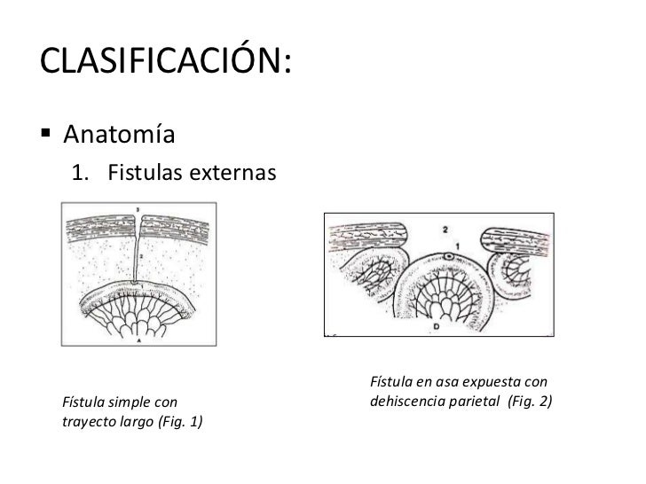 Fistulas