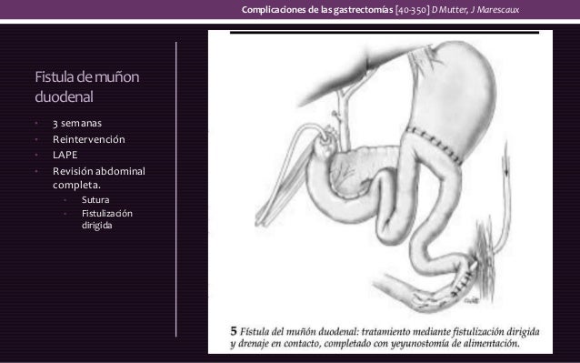 Fistulas