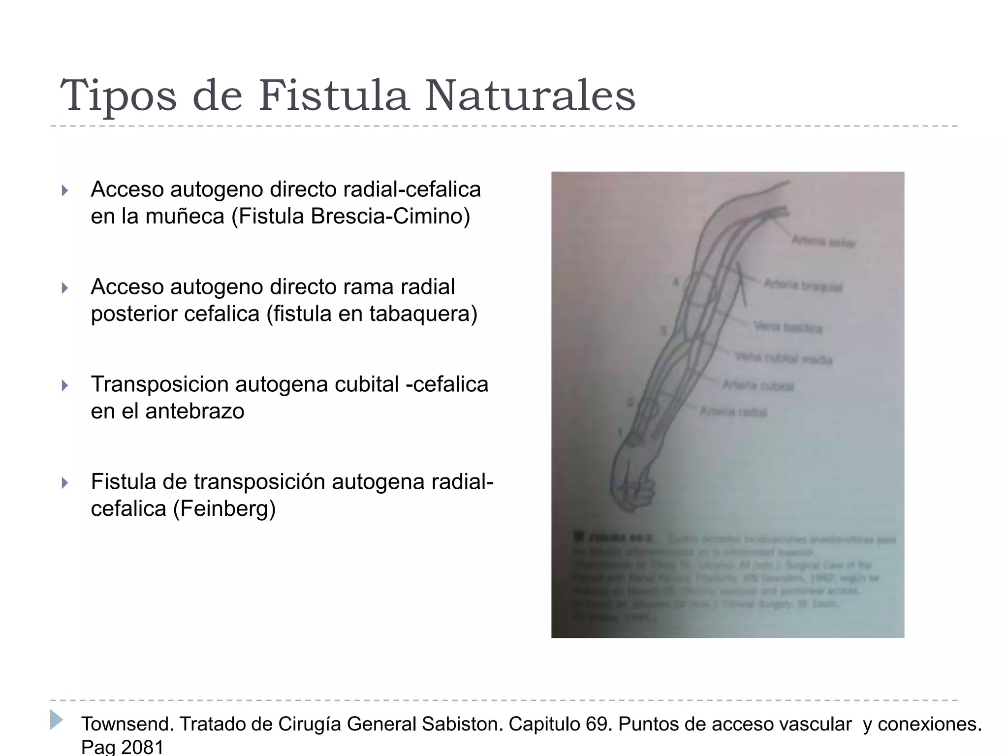 Fistulas arterio venosas | PPTX