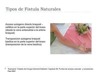 Fistulas arterio venosas | PPTX