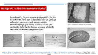 Fistulas intestinales.pptx
