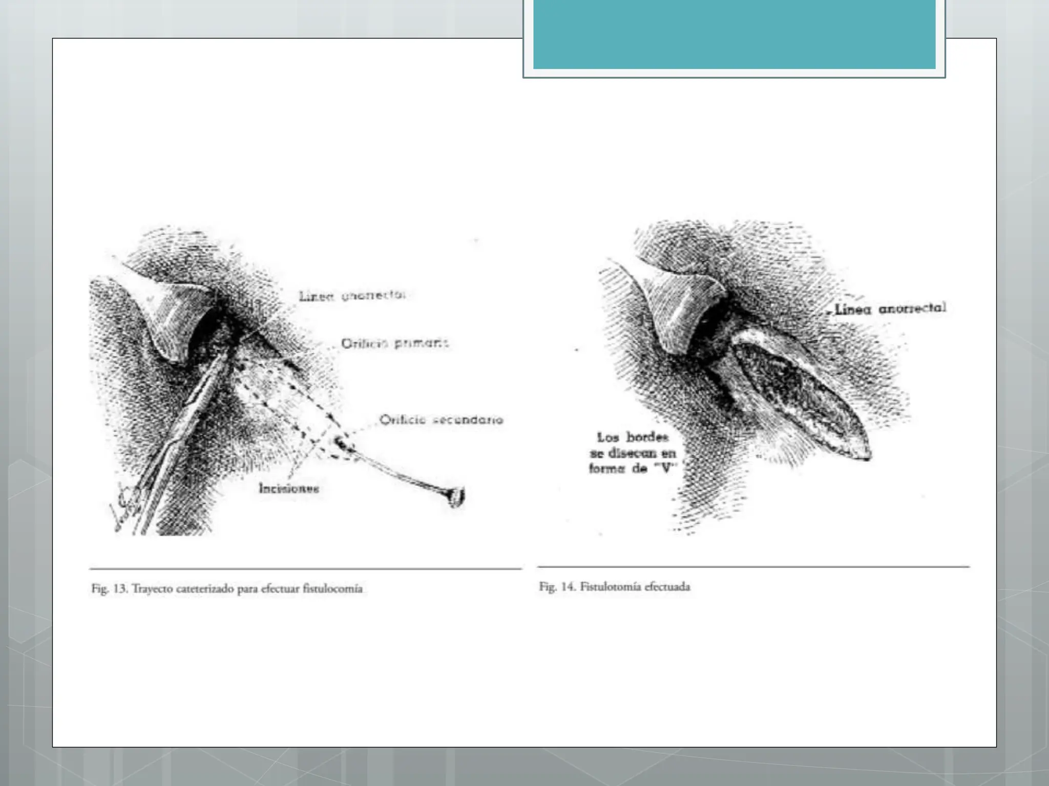 anatomia, abscesos y fistulas perianales | PPTX