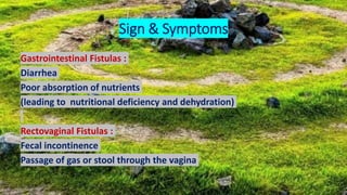 Fistulas presented by Shahzaib Saeed.pptx
