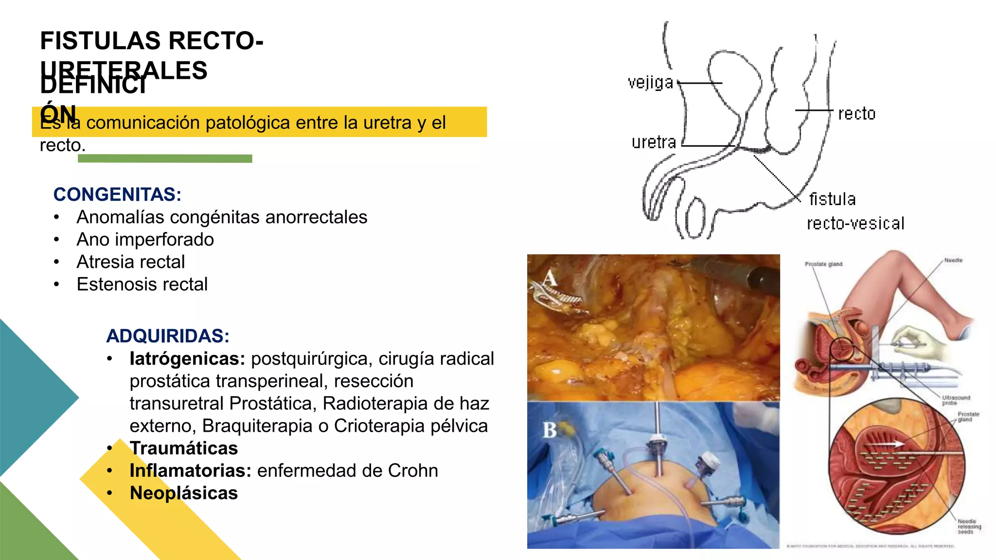 FISTULAS VERSION FINAL.pptx