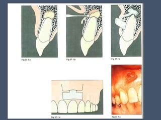 Fistulative and corrective surgery | PPTX