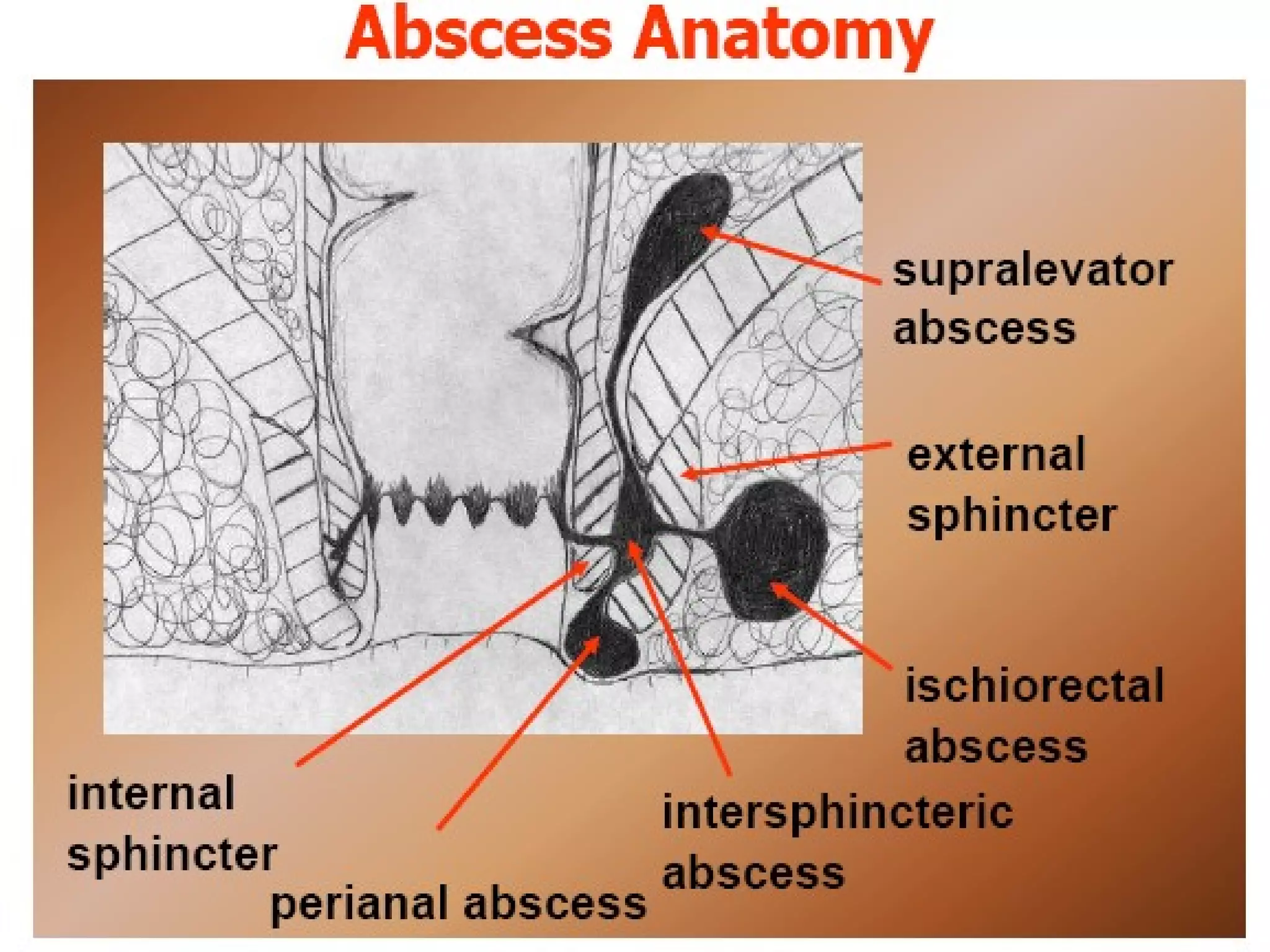 Fistula treatment by kshar sutra by dr dheeraj yadav | PPT