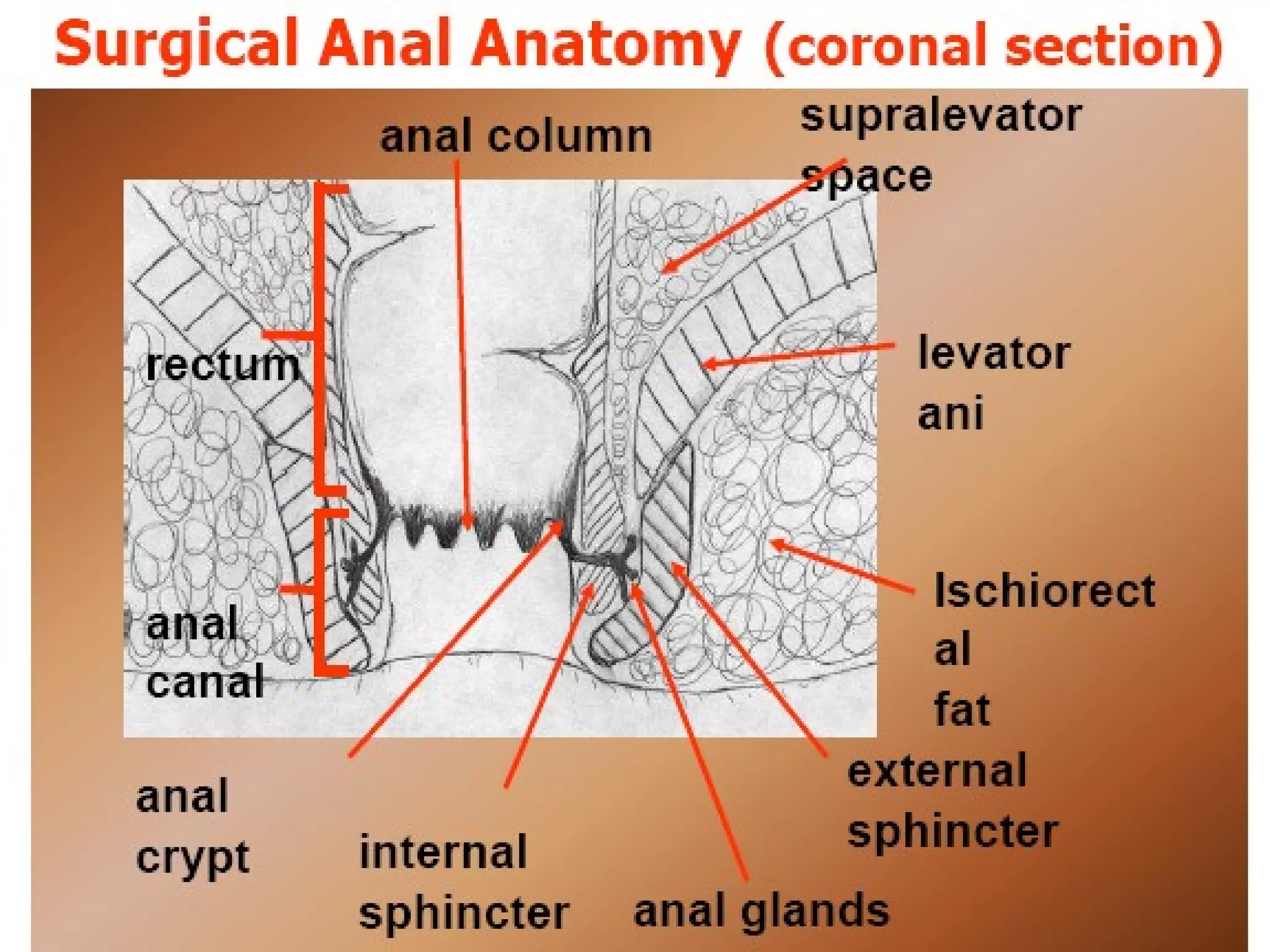 Fistula treatment by kshar sutra by dr dheeraj yadav | PPT