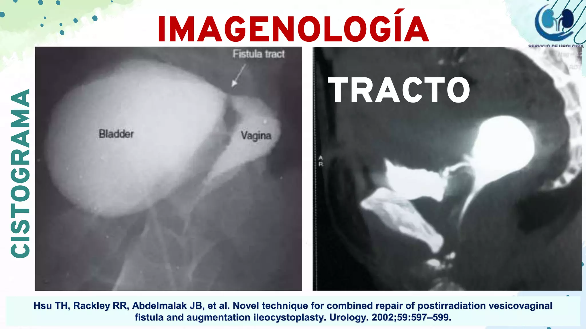 FISTULA VESICO VAGINAL.pptx