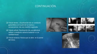 Fistulografia para estudiantes de medicina | PDF